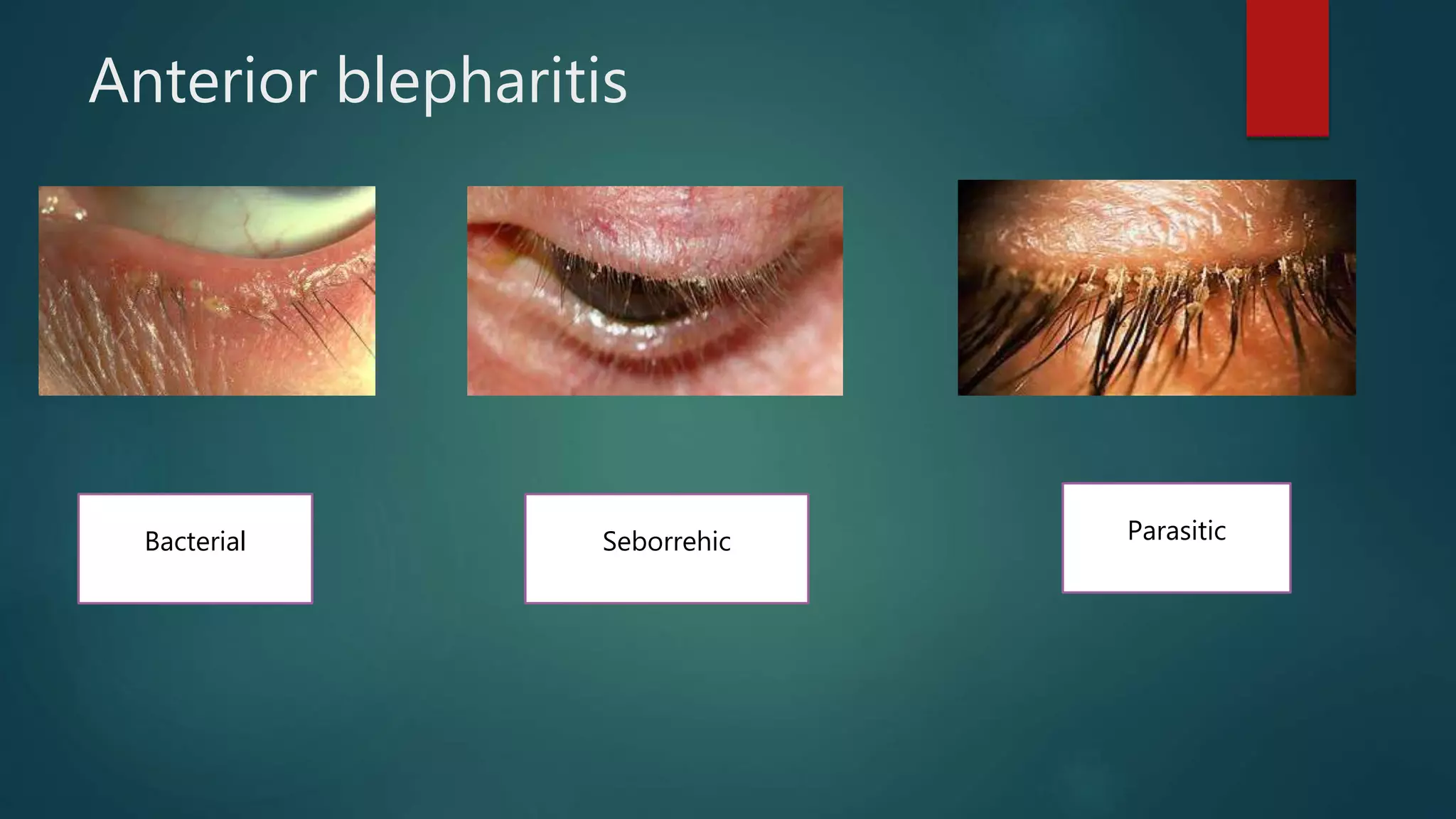 BLEPHARITIS ppt.pptx