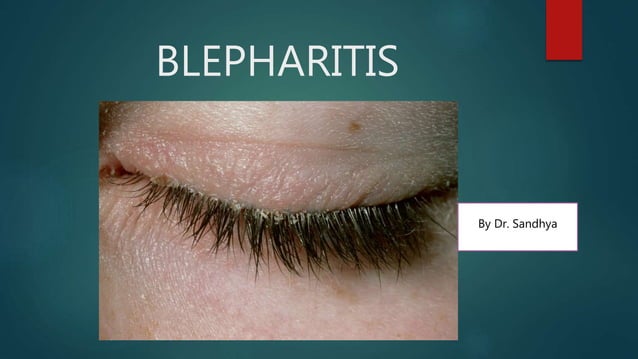 BLEPHARITIS ppt.pptx