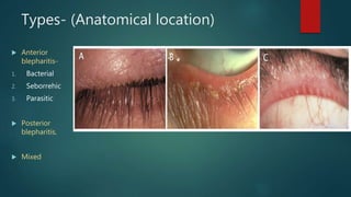 BLEPHARITIS ppt.pptx
