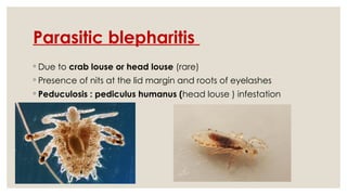 Blepharitis clinical features and management ppt | PPTX