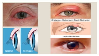 Blepharitis clinical features and management ppt | PPTX