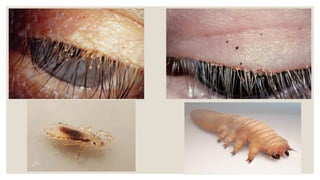Blepharitis clinical features and management ppt | PPTX