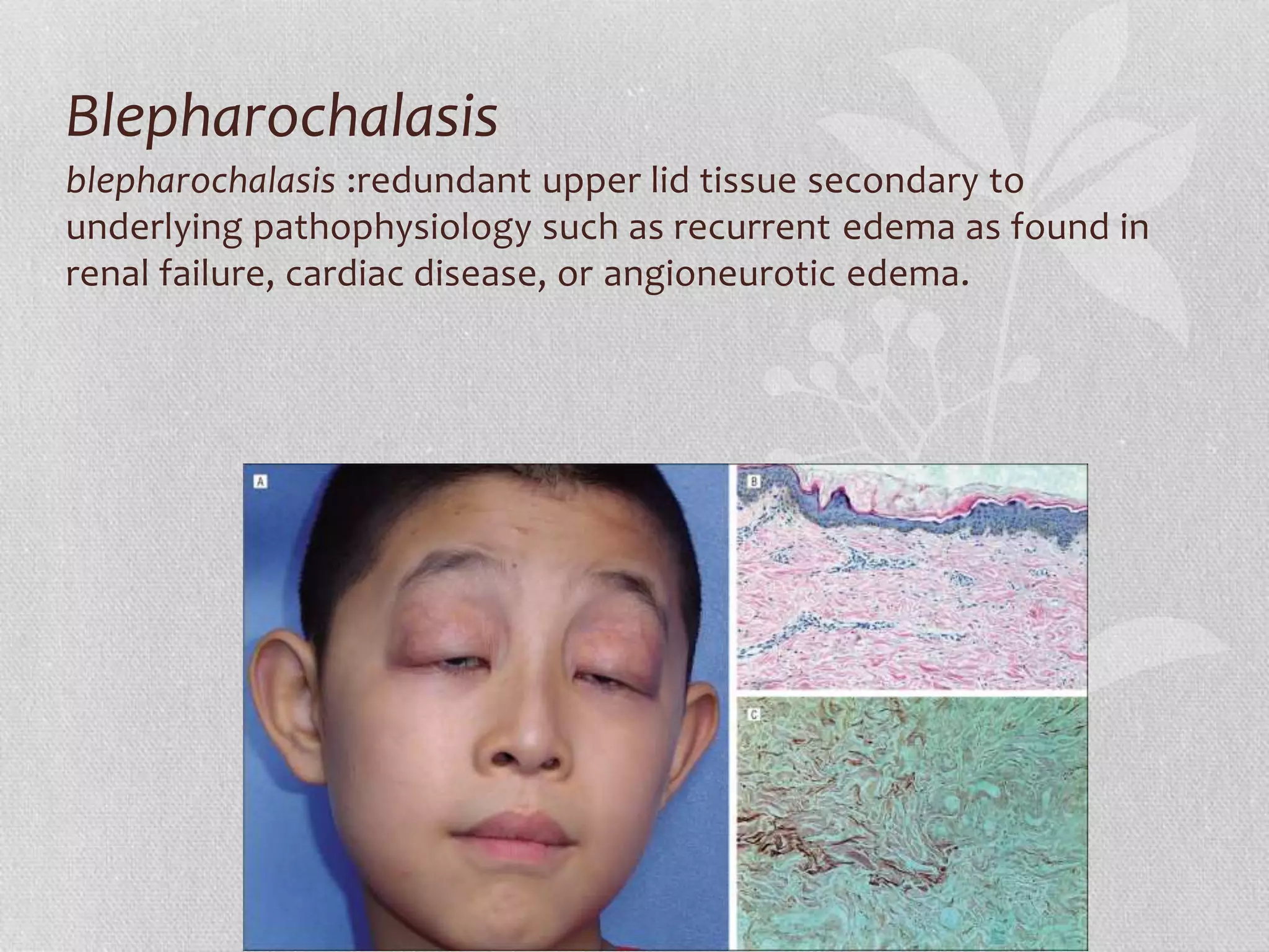 Blepharoplasty | PPTX