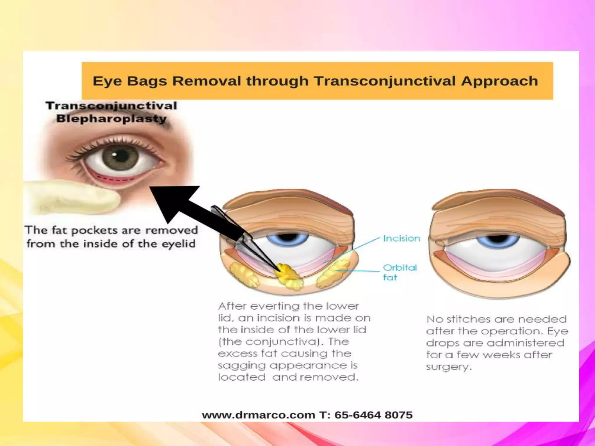 Blepharoplasty | PPTX