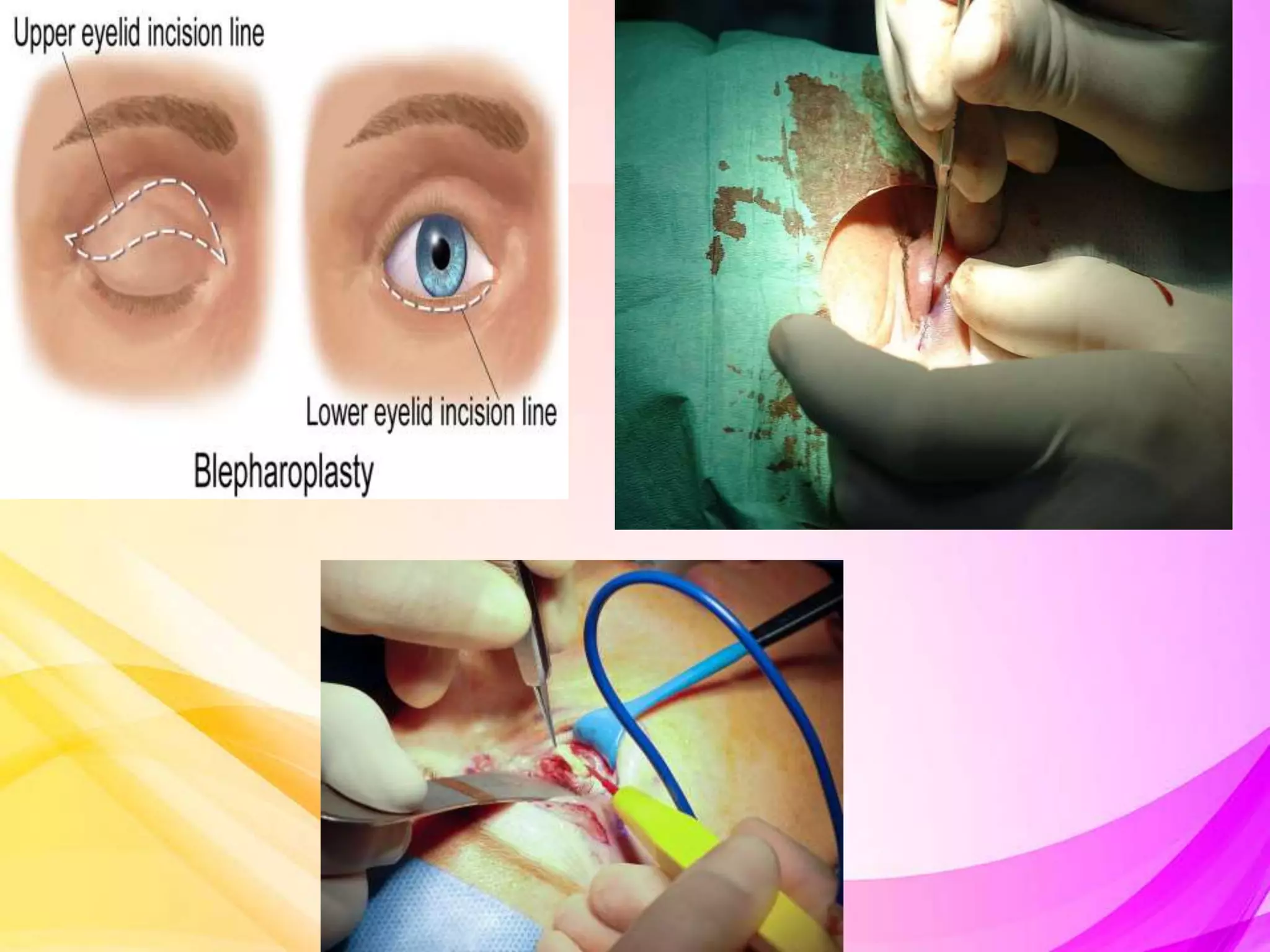 Blepharoplasty | PPTX