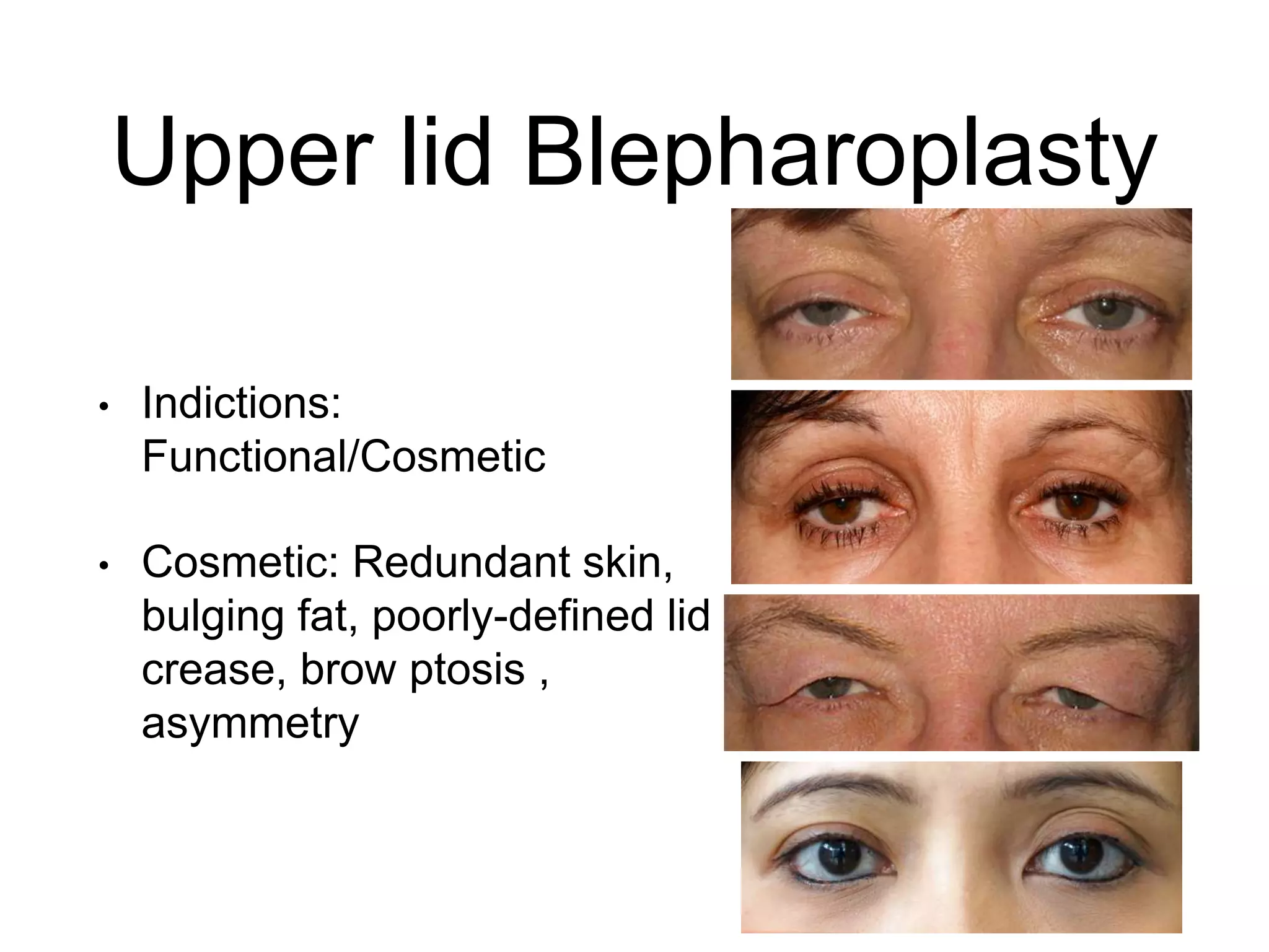 Blepharoplasty plastic meeting talk | PPTX | Eye and Vision Conditions ...