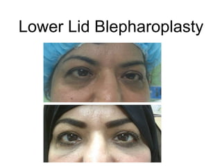 Blepharoplasty plastic meeting talk | PPTX