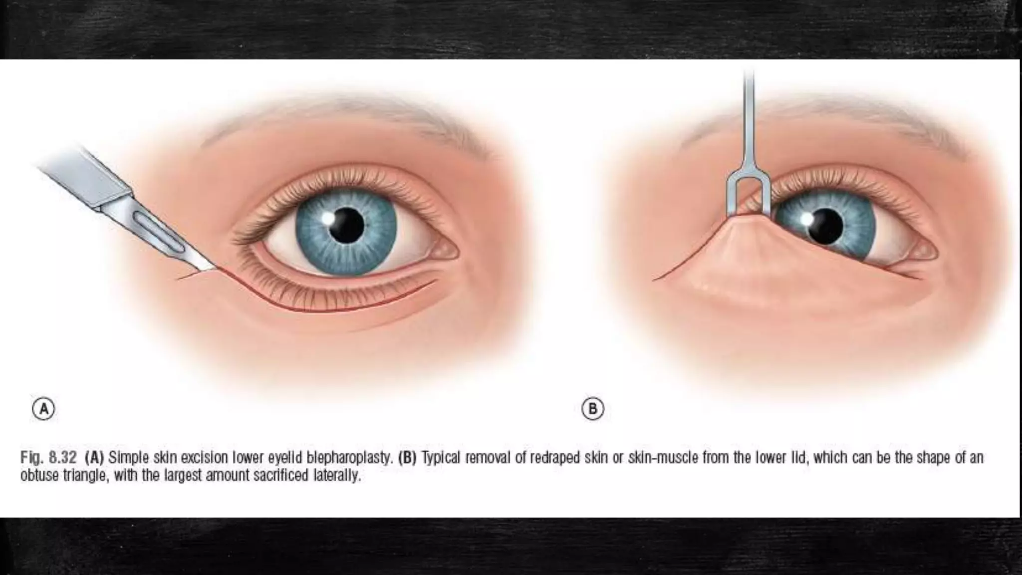 Blepharoplasty | PPTX