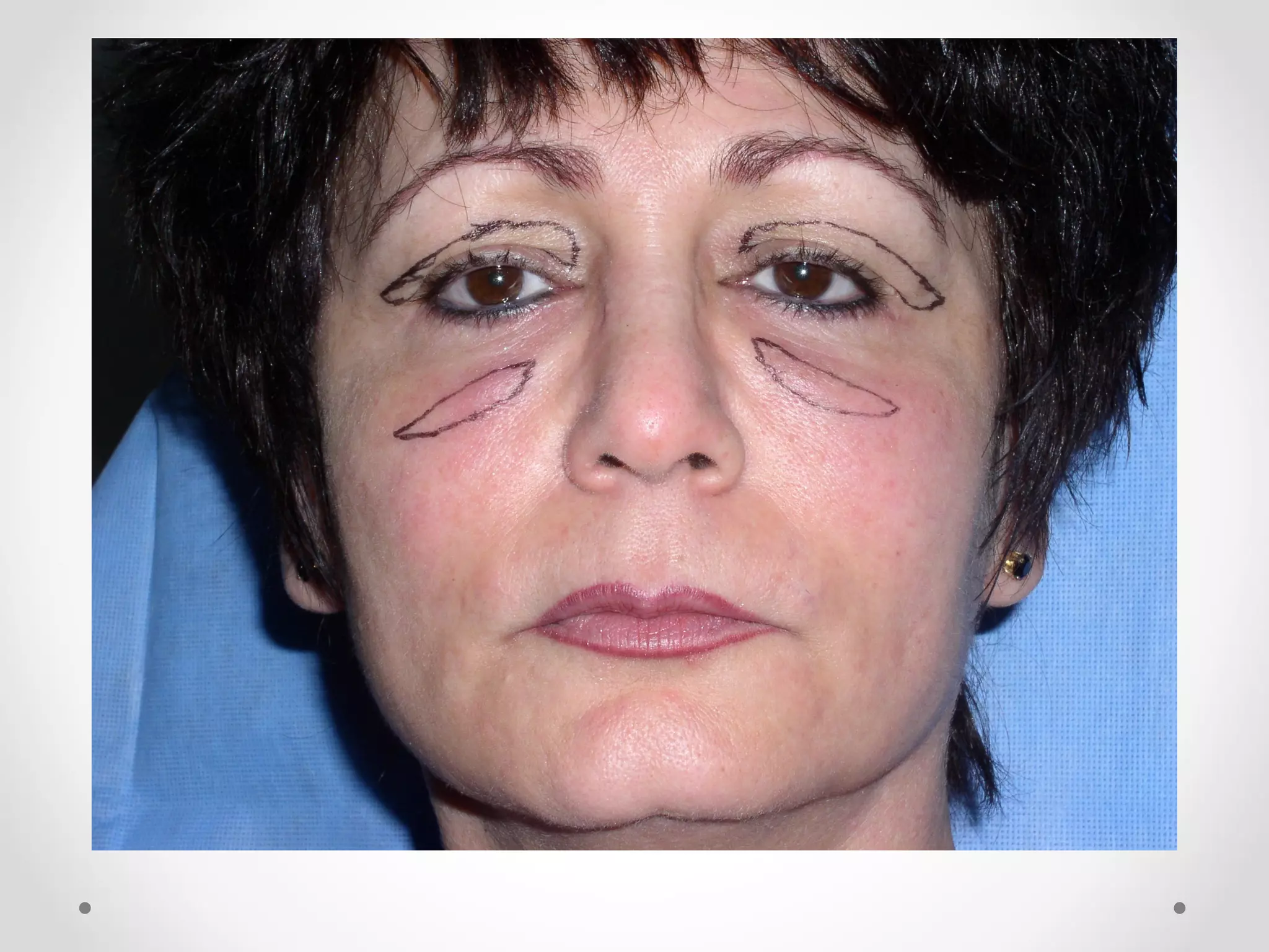 Blepharoplasty techniques | PPT