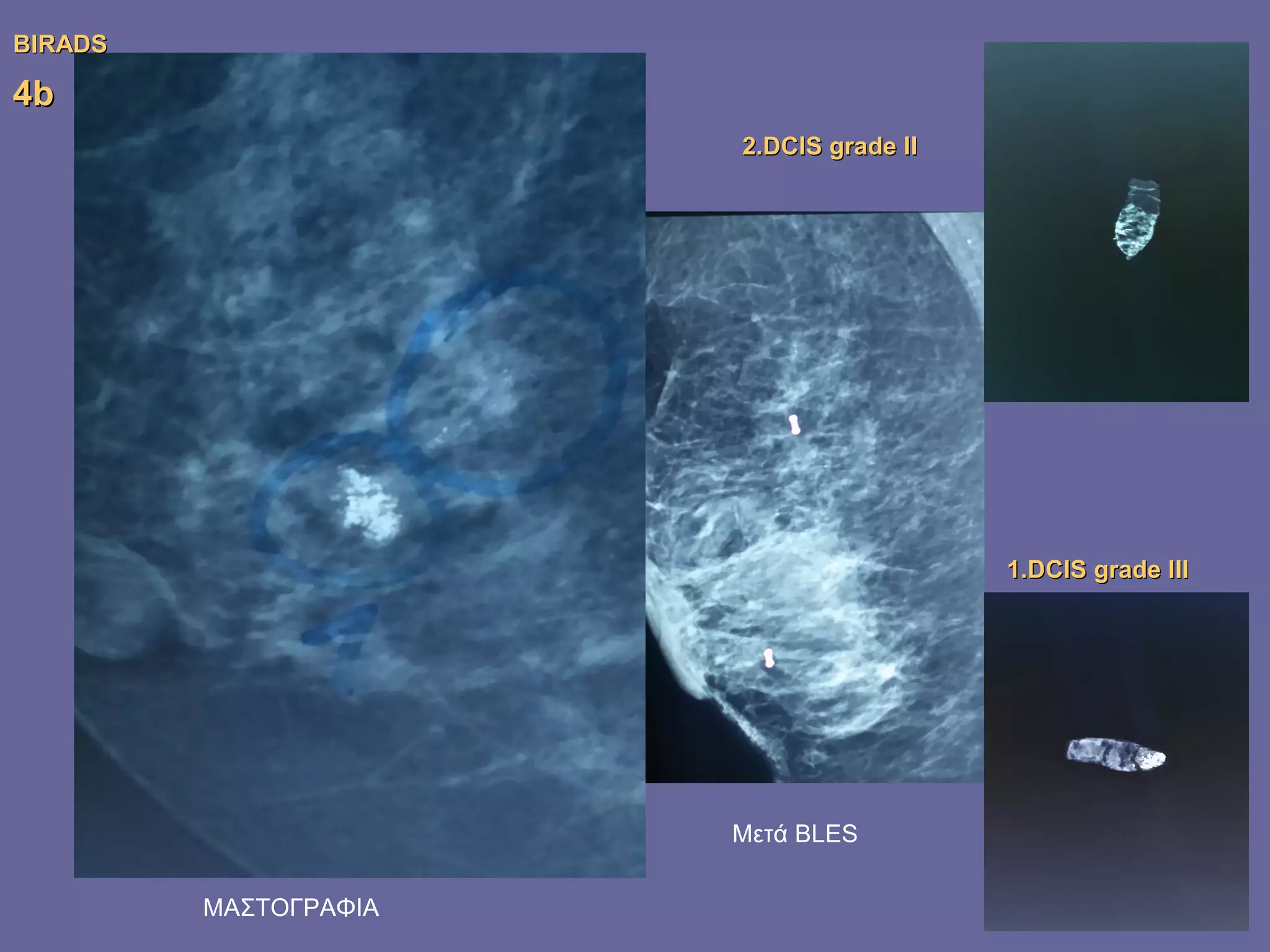 Bles μέθοδος στερεοτακτικής βιοψίας - αφαίρεση μικροαποτιτανώσεων | PPT