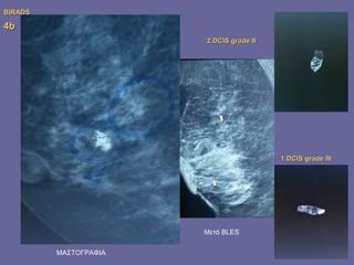 Bles μέθοδος στερεοτακτικής βιοψίας - αφαίρεση μικροαποτιτανώσεων | PPT