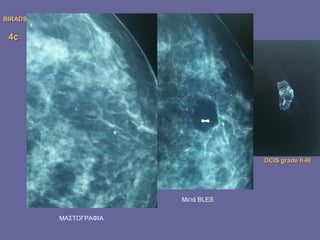 Bles μέθοδος στερεοτακτικής βιοψίας - αφαίρεση μικροαποτιτανώσεων | PPT