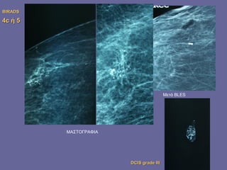 Bles μέθοδος στερεοτακτικής βιοψίας - αφαίρεση μικροαποτιτανώσεων | PPT