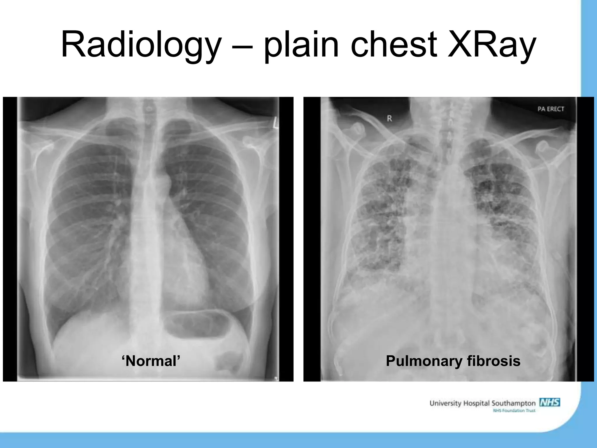 What is Pulmonary Fibrosis? | PPTX