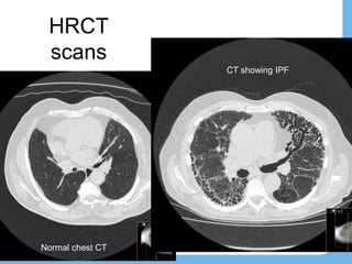 What is Pulmonary Fibrosis? | PPTX