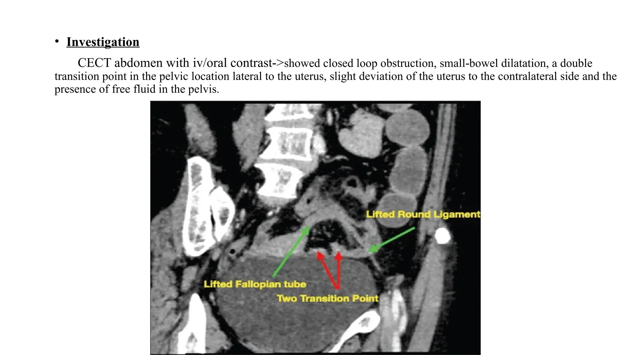 A unusal case of small bowel obstruction broad ligament hernia | PPTX