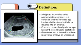 POWERPOINT PRESENTATION ABOUT BLIGHTED OVUM | PDF