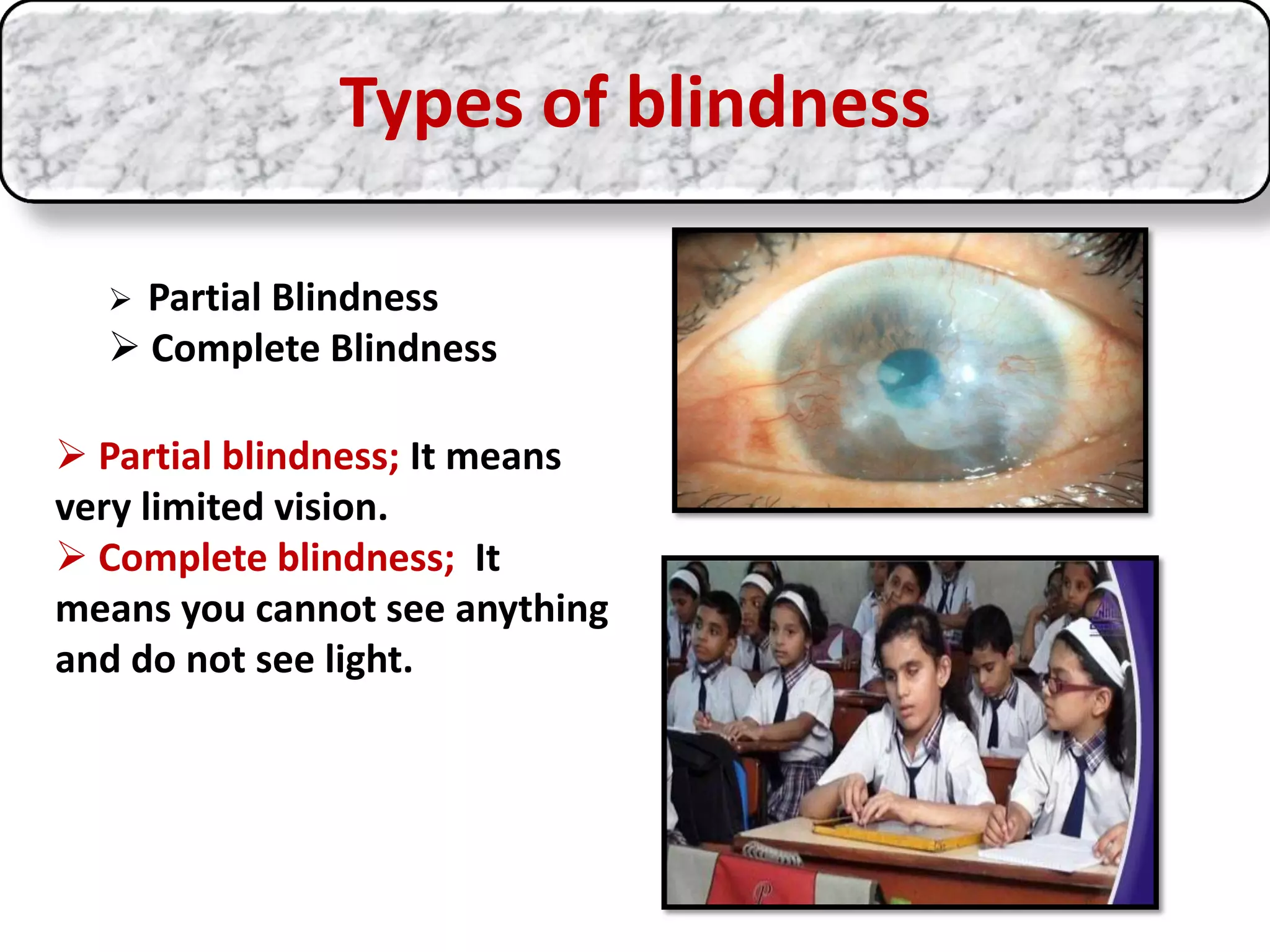 Blindness | PDF | Eye and Vision Conditions | Diseases and Conditions