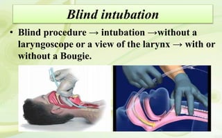 Blind oral and nasal intubation | PPTX