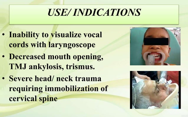 Blind oral and nasal intubation | PPTX | Ear, Nose and Throat ...