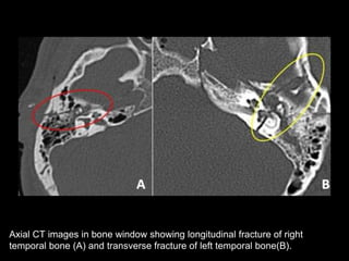 Blind spot in brain imaging | PPTX