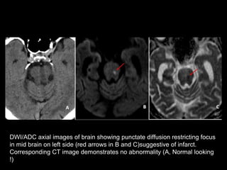 Blind spot in brain imaging | PPT