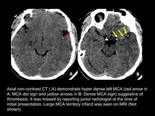 Blind spot in brain imaging | PPTX