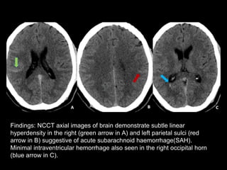 Blind spot in brain imaging | PPTX
