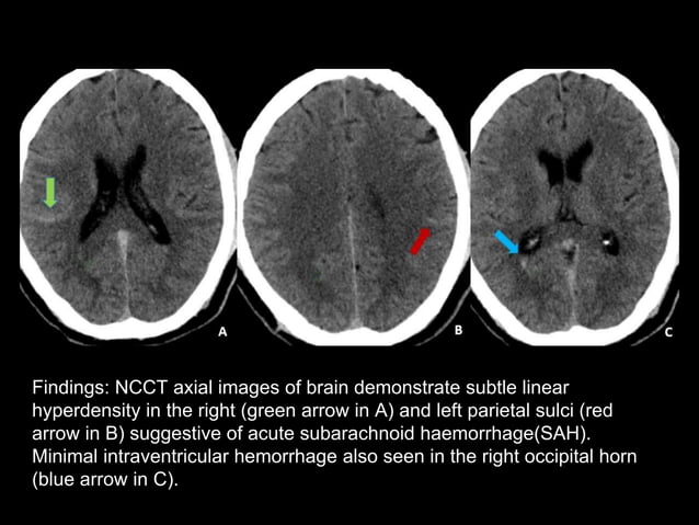 Blind spot in brain imaging | PPT