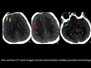 Blind spot in brain imaging | PPT