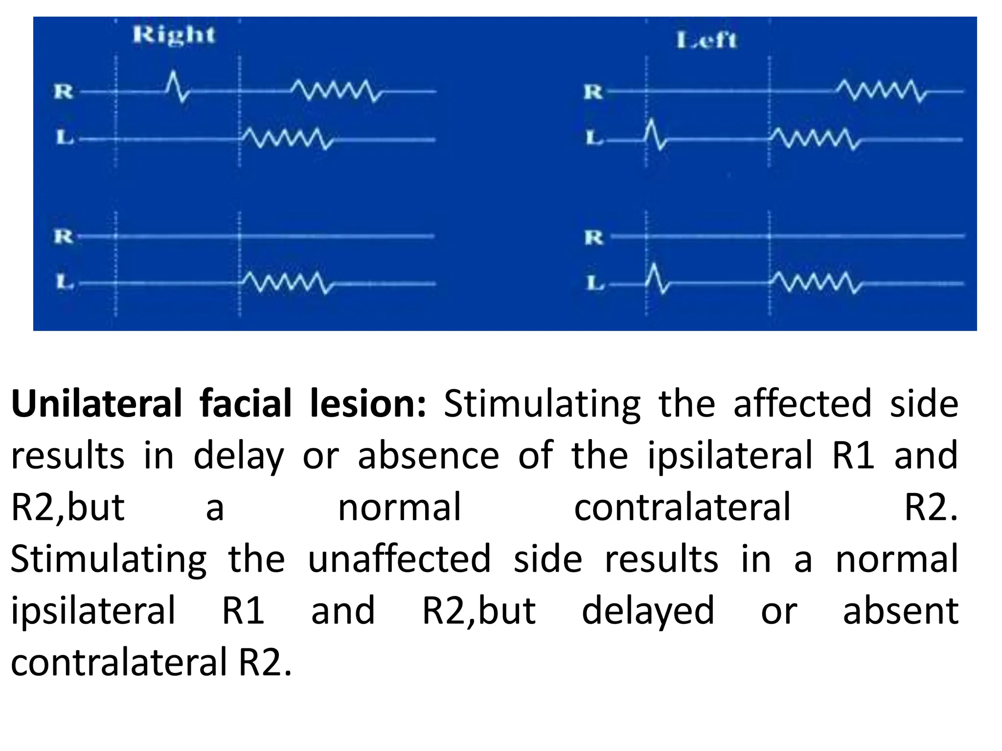 blink reflex nerve conduction velocity test | PPTX