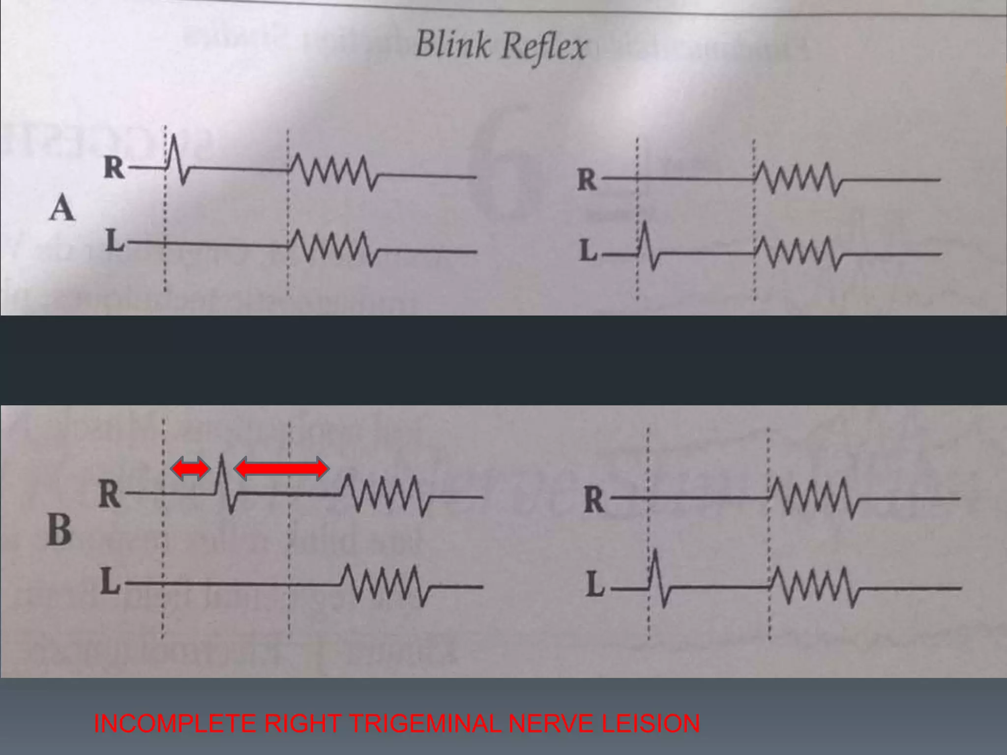 Blink reflex 1 | PPTX