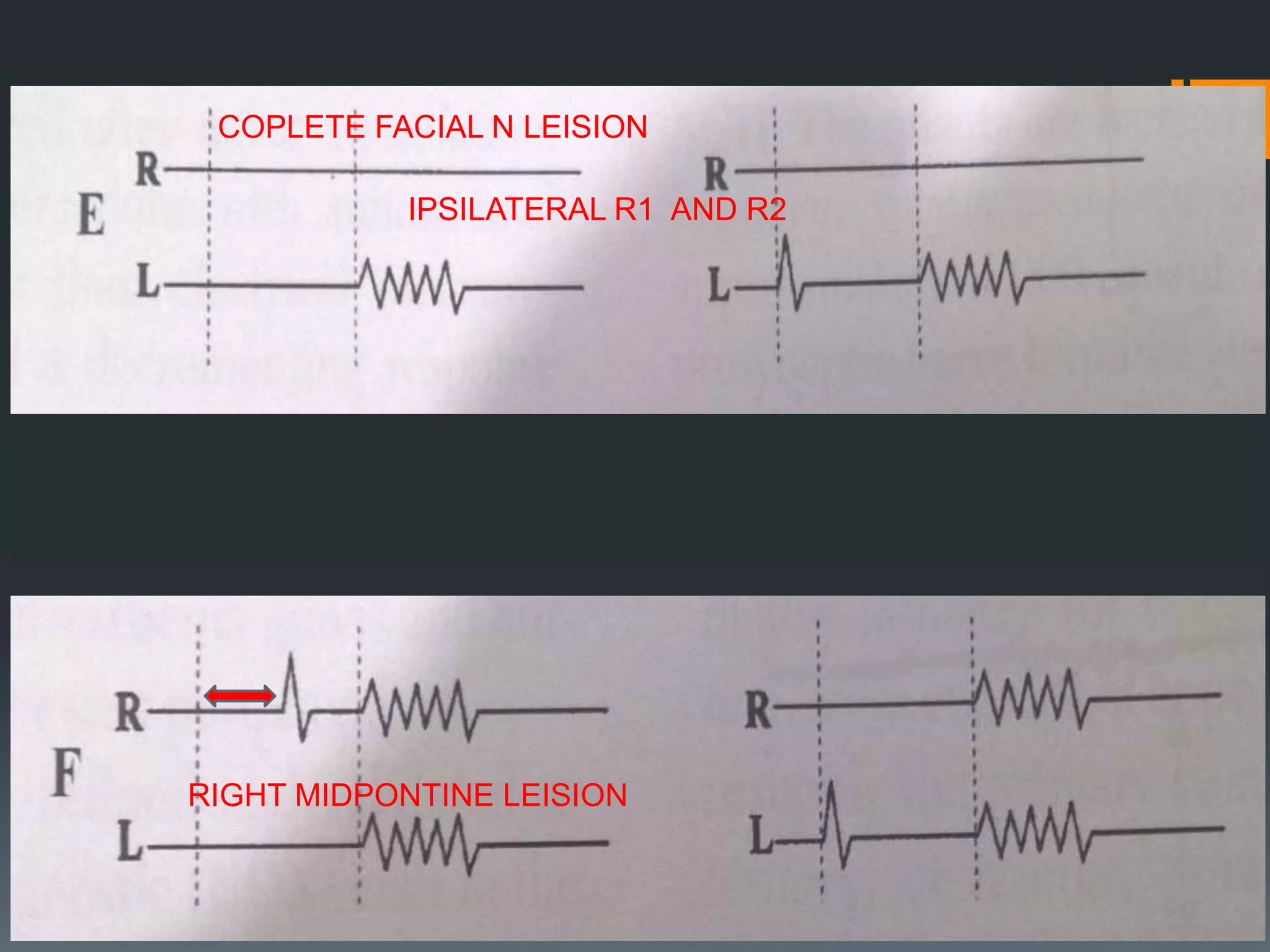 Blink reflex 1 | PPTX