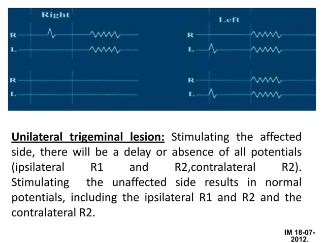 Blink reflex | PPTX | Brain and Nervous System Disorders | Diseases and ...