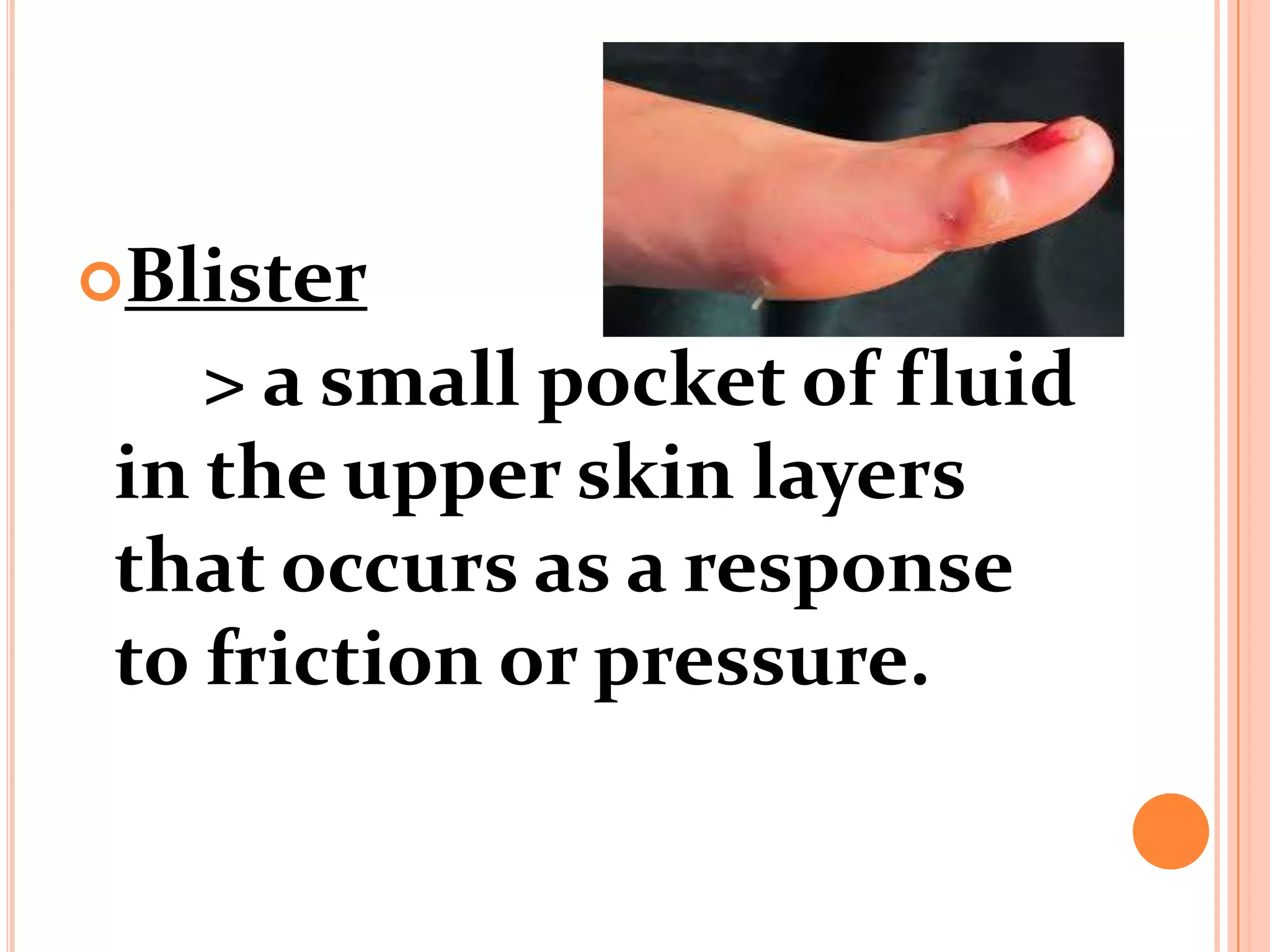 Blister first aid | PPTX