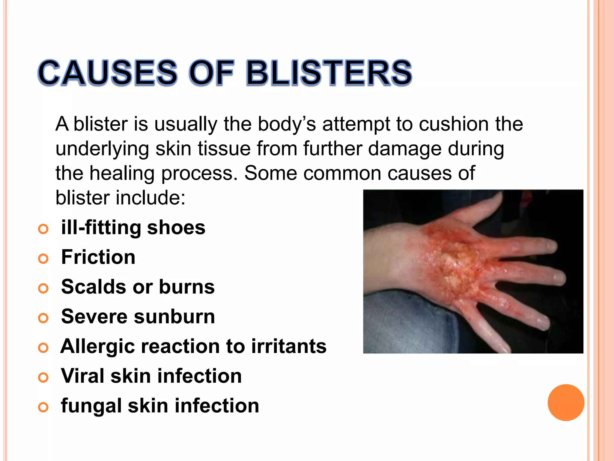 Blister first aid | PPTX