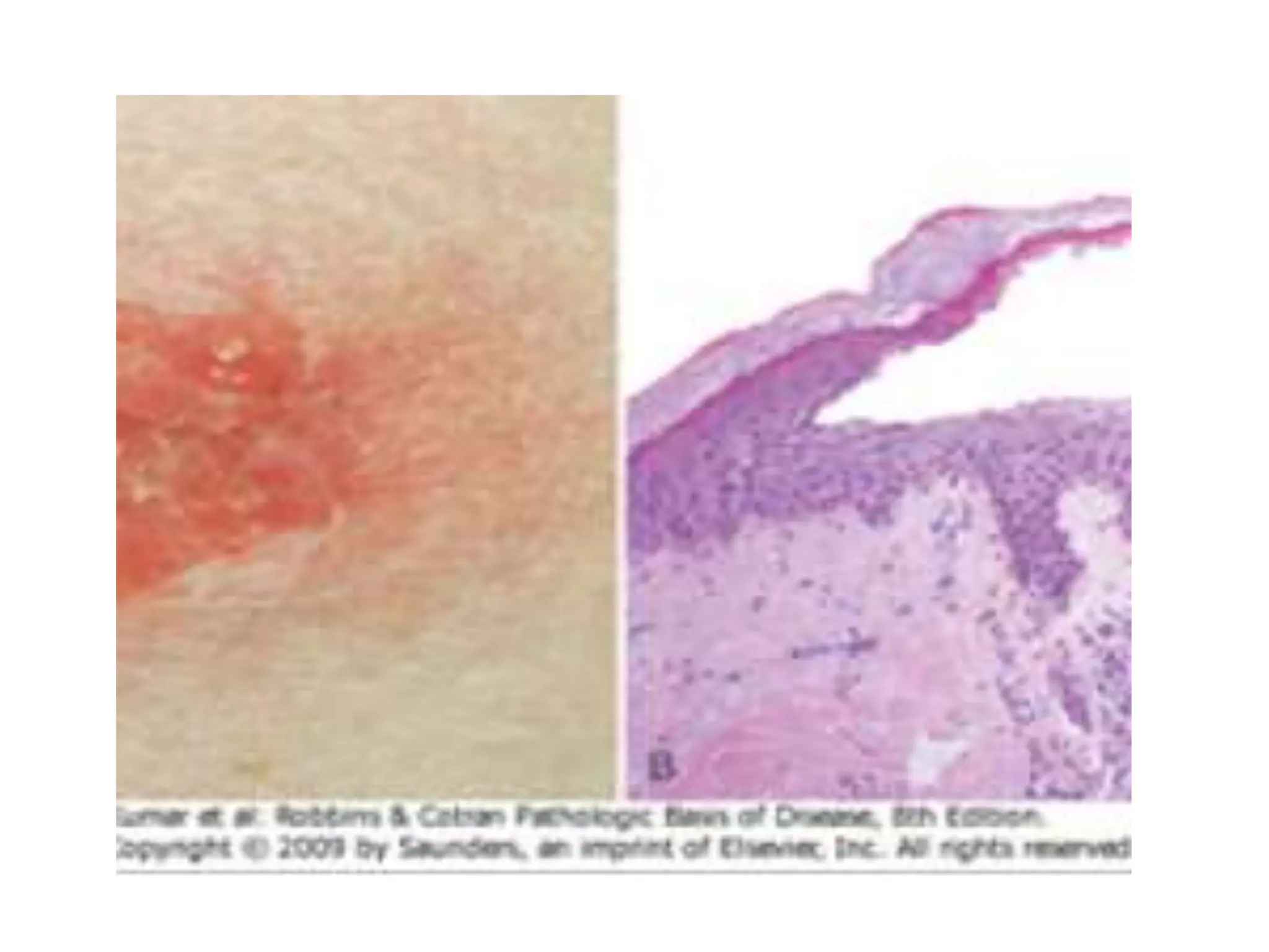 Blistering Bullous Disease by dr shahida kashif | PPTX