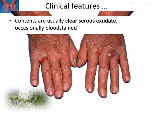 Blistering skin diseases in elderly | PPTX | Skin and Dermatology ...