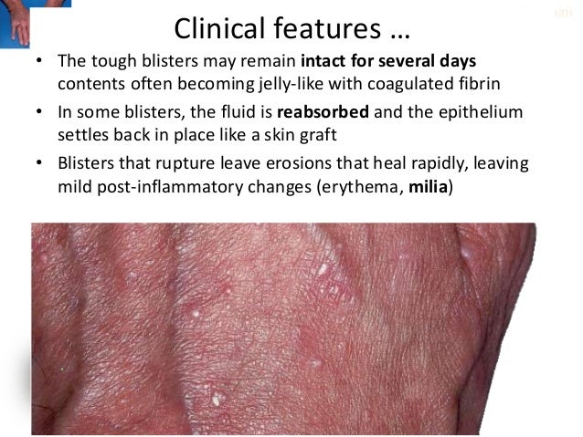 Blistering skin diseases in elderly