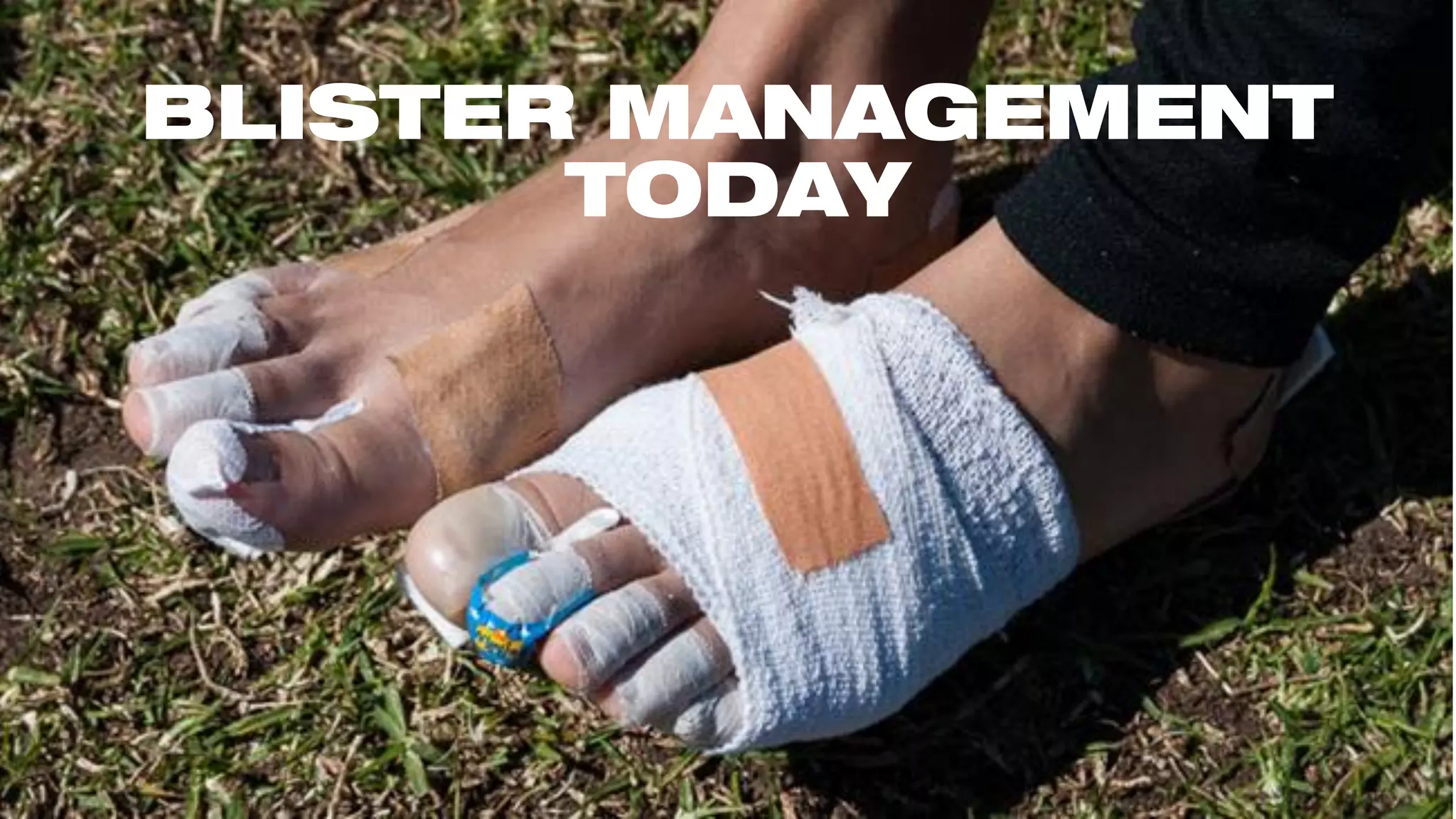 Blister Prevention for Podiatrists | PDF