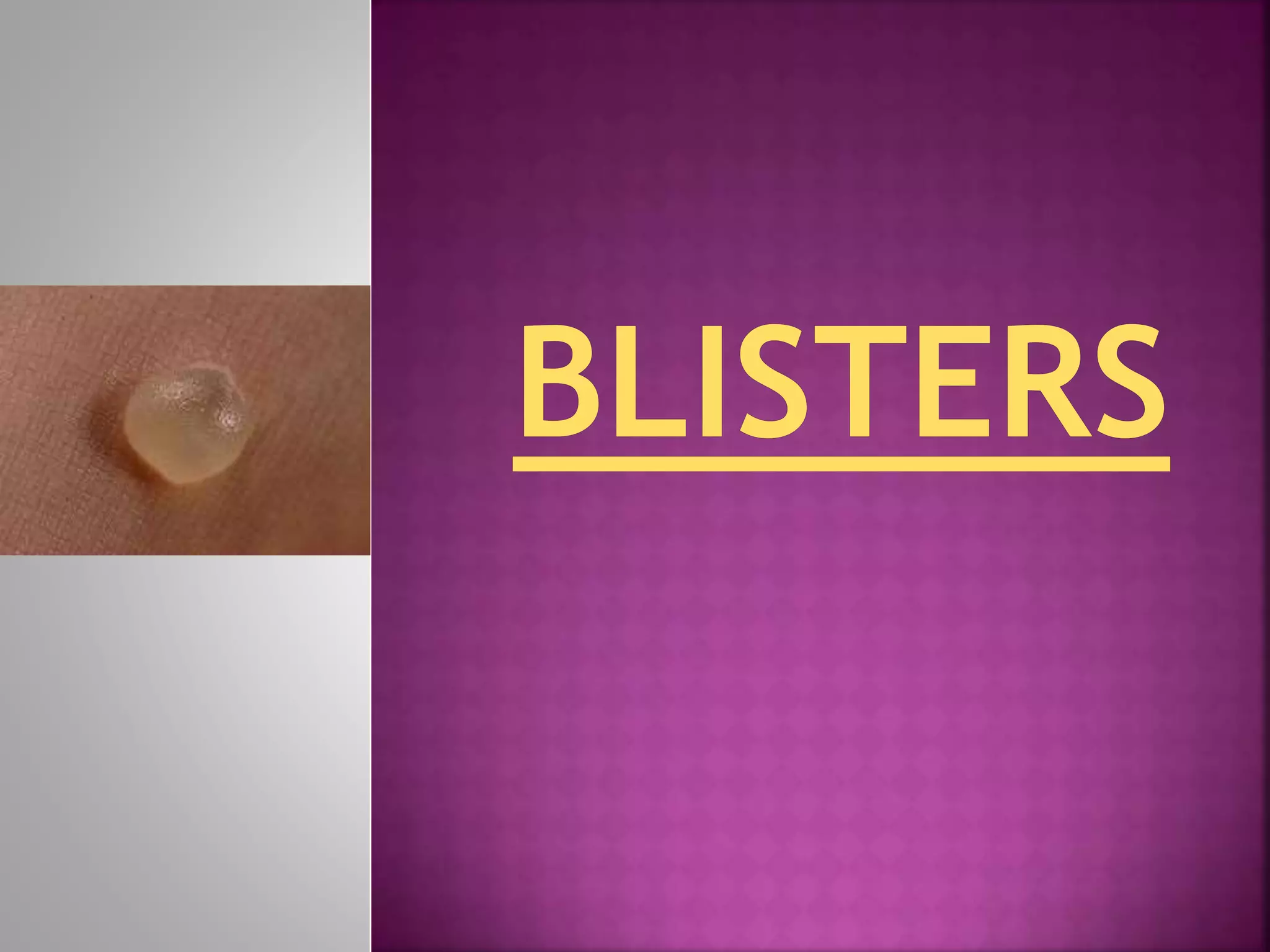 Blisters | PPTX