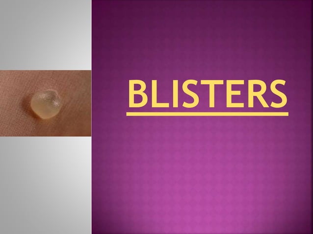 Blisters | PPTX | Skin and Dermatology | Diseases and Conditions