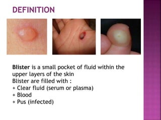 Blisters | PPTX