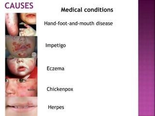 Blisters | PPTX