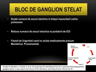 Stelate Ganglion Percutaneous Block | PPTX