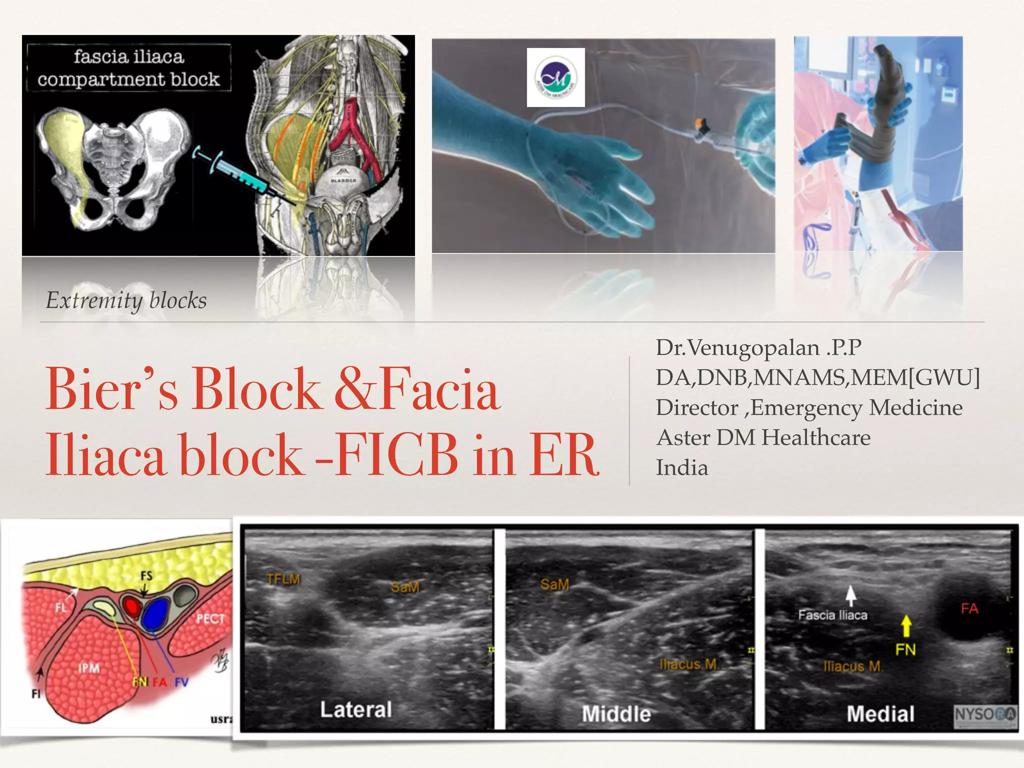 Fascia Iliaca and Biers blocks in Emergency room | PDF