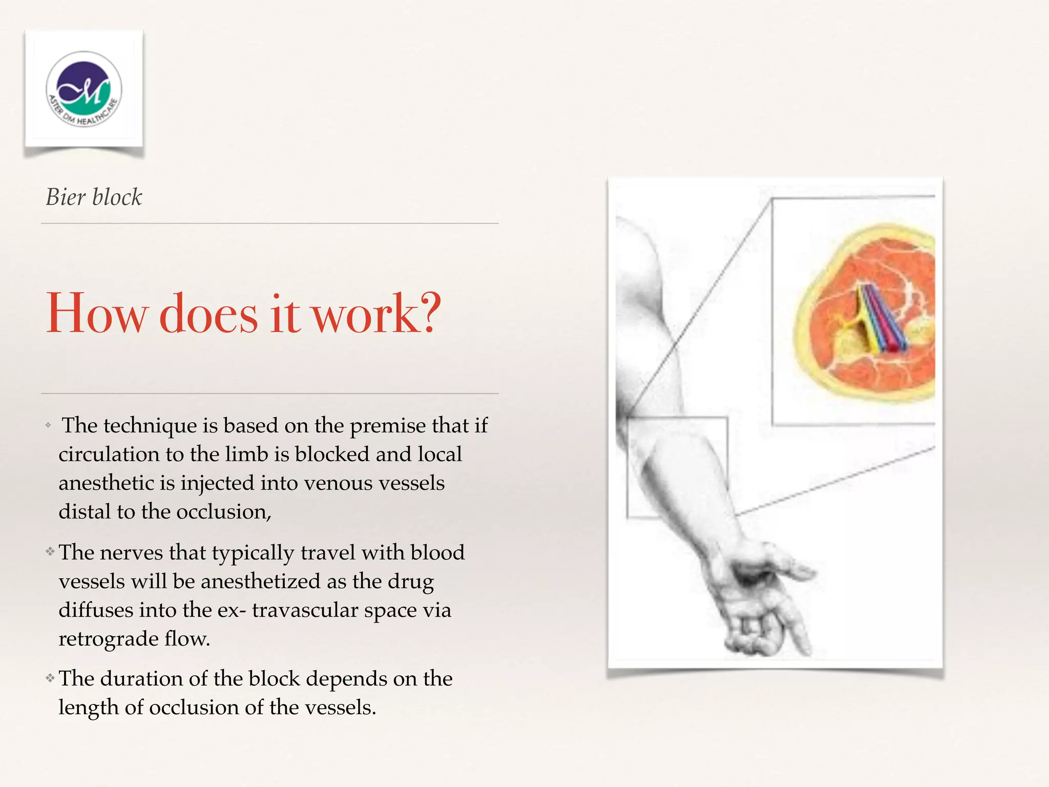 Fascia Iliaca and Biers blocks in Emergency room | PDF