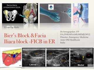 Fascia Iliaca and Biers blocks in Emergency room | PDF