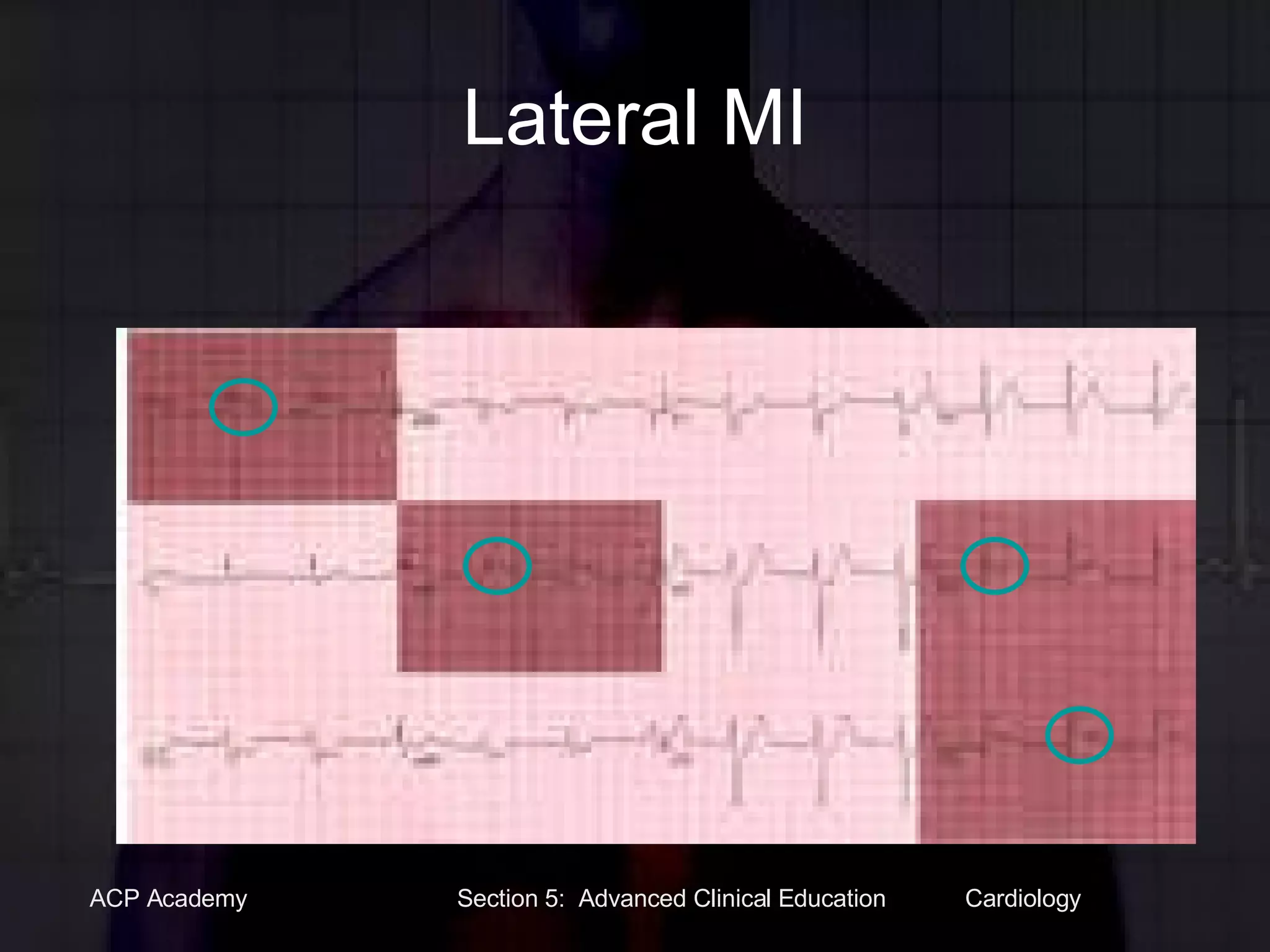 STEMI, N-STEMI, and Everything else | PPT