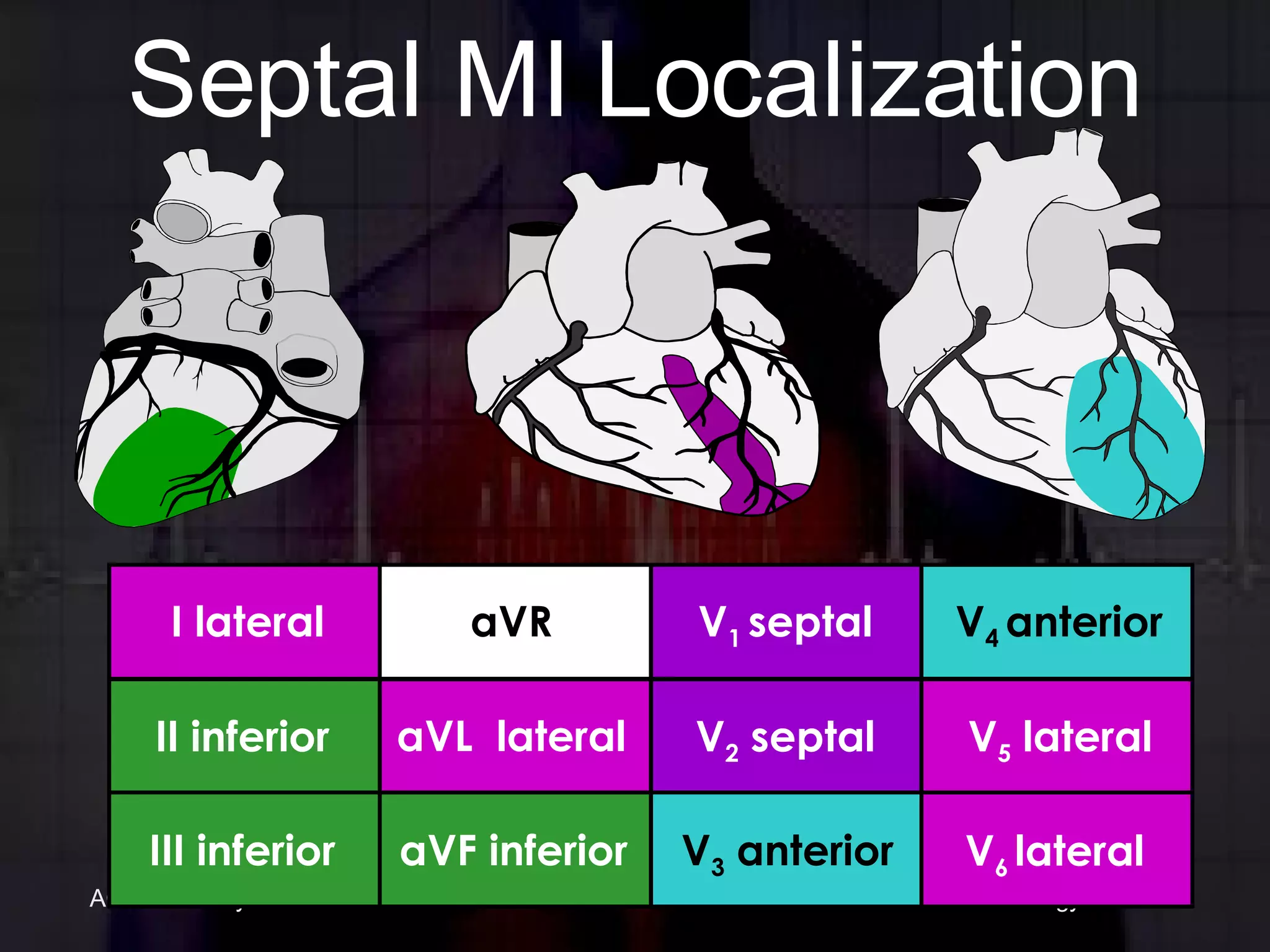 STEMI, N-STEMI, and Everything else | PPT